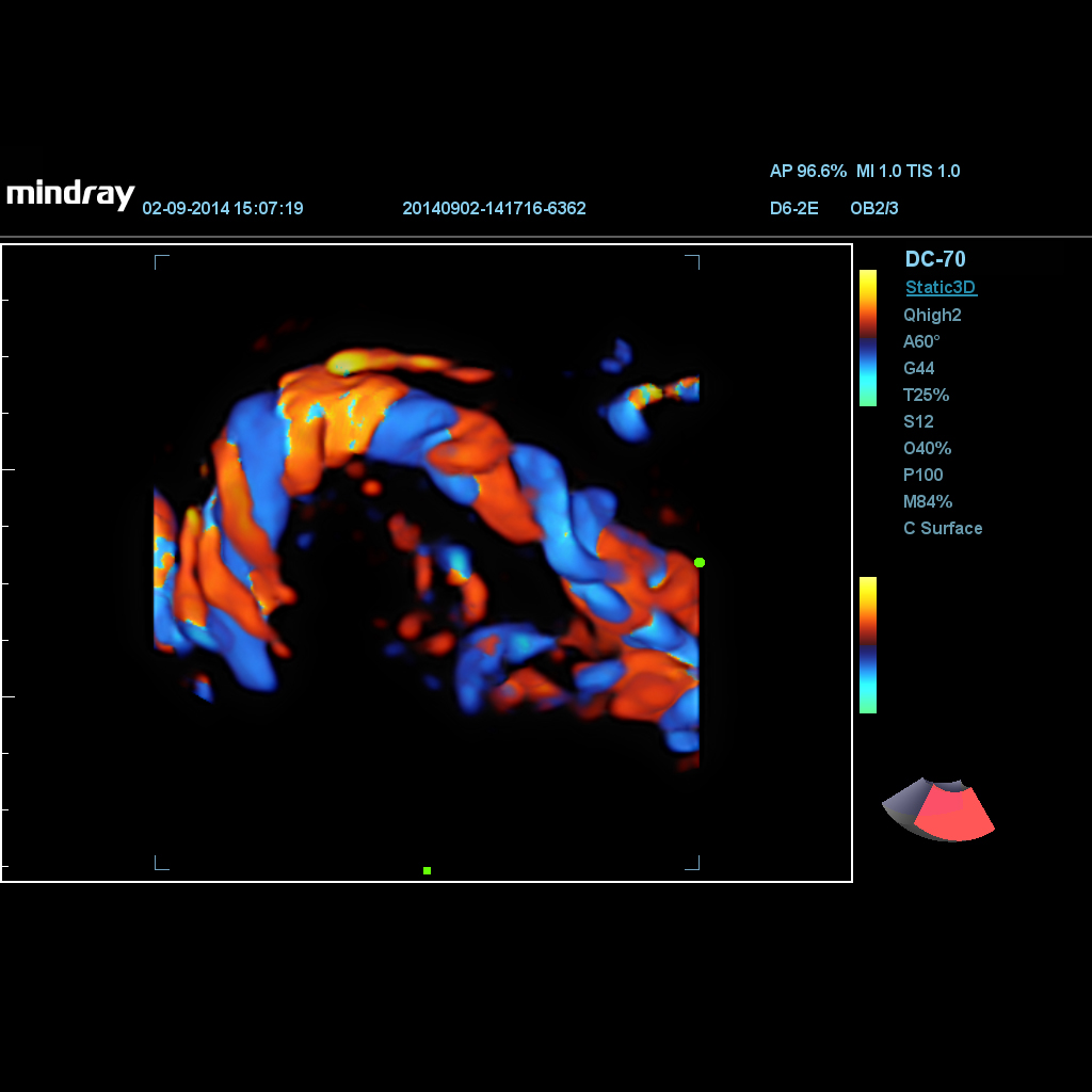 Color 3D - Софтуер за ехограф Mindray | Infinita_BG